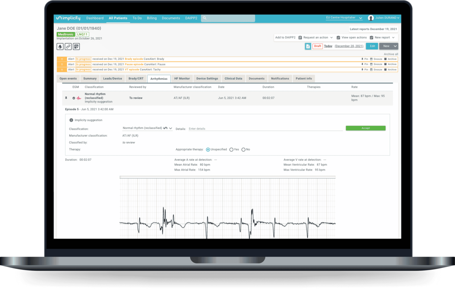 ILR ECG Analyzer - Implicity